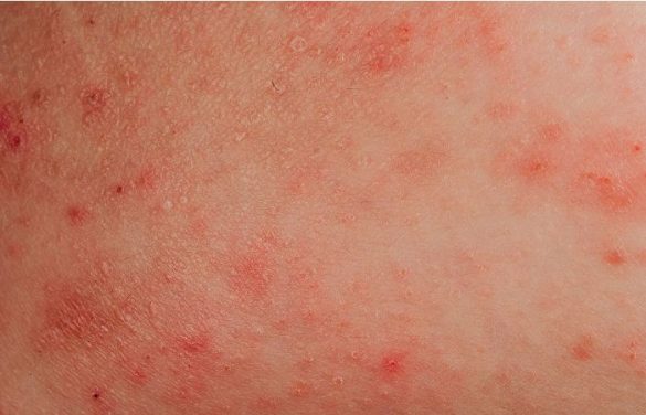 Skin Rashes Write For Us, Guest Post, And Submit Post